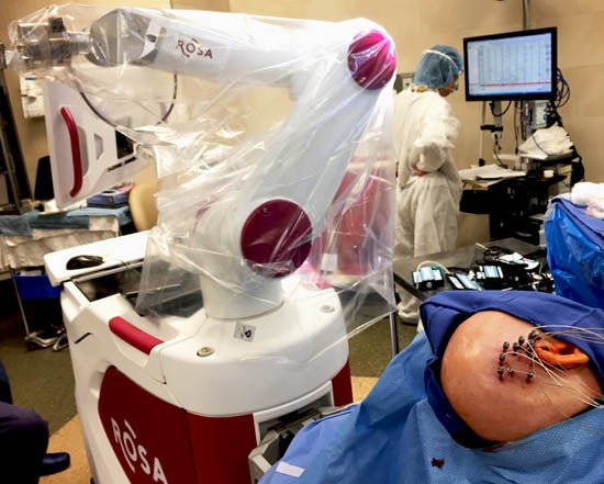 ROSA (Robotic Stereotactic Assistance) | Neurological Surgery ...